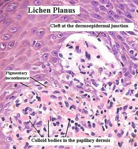 Medicine Decoded: Lichen planus